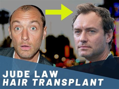 Jude Law Hair Transplant Hair Loss Technical Analysis