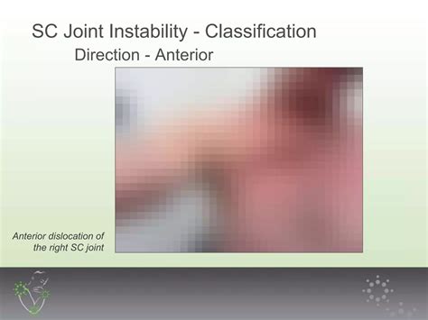 The Sternoclavicular Joint Pptx