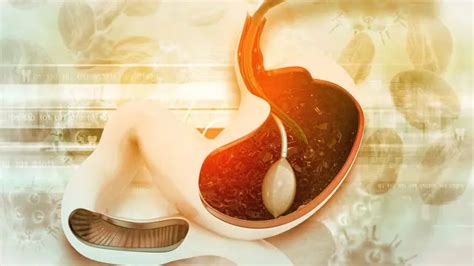 Gastric Balloon Weight Loss Procedure