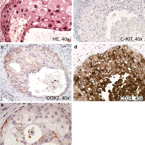 Immunohistochemical Staining Of Apocrine Metaplasia Without Atypia A
