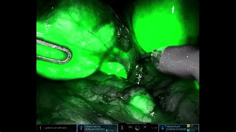 Robotic Cholecystectomy Da Vinci Xi Firefly Youtube