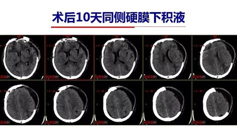 Dc术后硬膜下积液合并脑内积水的相关因素及处理 颅脑创伤 神经重症病例周刊（123期） 脑医汇