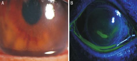 摇 Persistent Corneal Epithelial Defect 摇 A Corneal Epithelial Defect