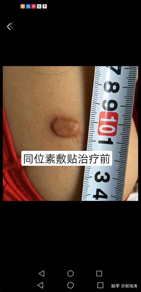 疤痕疙瘩同位素敷贴你知道多少？ 知乎