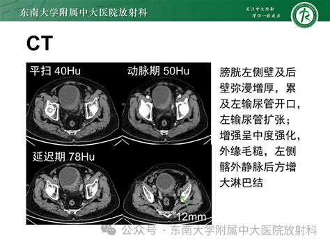 膀胱壁增厚病变 医学界 助力医生临床决策和职业成长