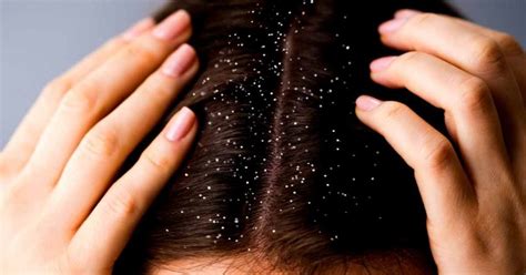 Can I Eliminate Dandruff With Tea Its Never Not Teatime