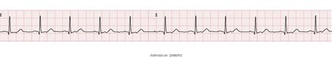 Banner Ecg Example Normal Sinus Rhythm Stock Illustration 2246863913