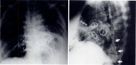 A And B Radlographs Show Compression Atelectasis Of Left Lower Lobe