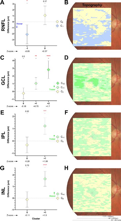 Figure 1 From Reticular Pseudodrusen Are Associated With More Advanced Para Central