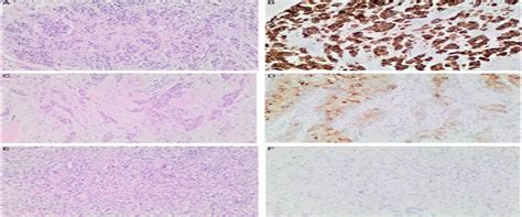 Distinct Uroplakin Ii Staining Pattern In Apocrine Breast Ca