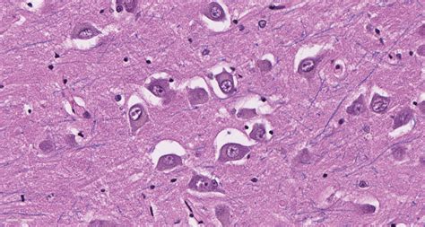 Cowdry Type B Inclusion Bodies