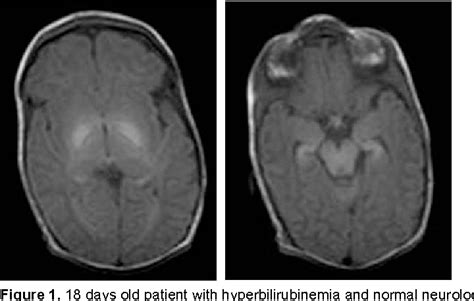 Cranial Magnetic Resonance Imaging Findings In Patients With Indirect