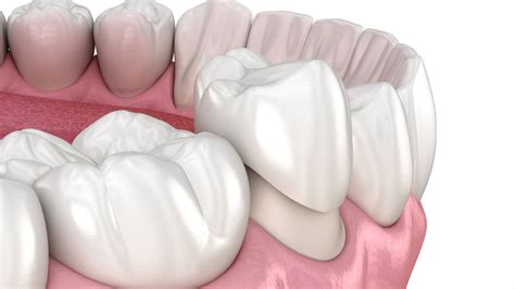 4 Signs Your Dental Crown Needs To Be Replaced Hinsdale Dental