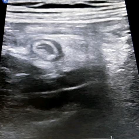 Mucocele Appendix With Appendicolith Radiology Radiodiagnosis