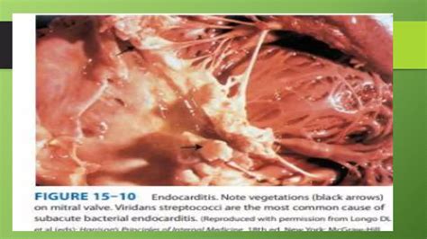 Streptococcus Viridans Bacteria Microbiology Lecture Pptx