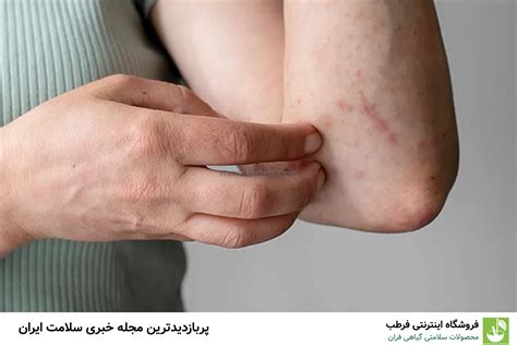 راهکارهای مؤثر برای درمان قارچ پوستی