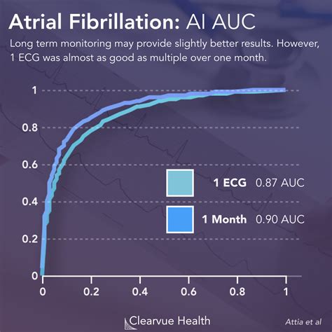 4 charts ai diagnoses atrial fibrillation in normal sinus rhythm