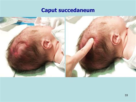 Ppt Normal Newborn Care Neonatal Care Powerpoint Presentation Free Download Id 5740986