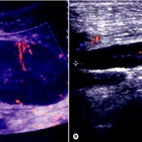 Ultrasonographic Visualization Of A Subcutaneous Lymph Node With