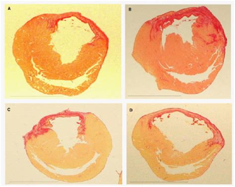 Histological Analysis Of The Infarcted Hearts After Stem Cell