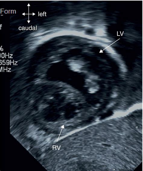 18 Pulmonary Atresia With Intact Ventricular Septum Veterian Key