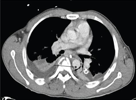Chest Ct Scan Shows A Air Leak Around The Esophagus And B