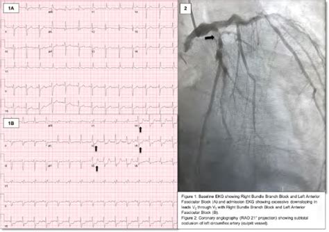 Right Bundle Branch Block With Severe Right Precordial St Segment