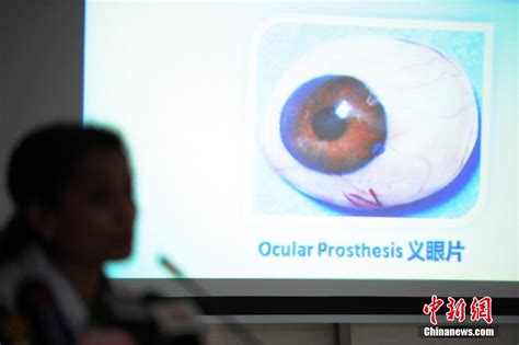 山西被挖双眼儿童两周后出院 组图 图片中国中国网