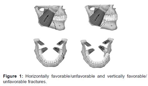 Newer Proposed Classification Of Mandibular Fractures A Critica