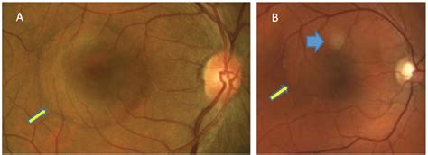 Review Of Optometry Women With Csc Have Worse Sleep Compared With Men