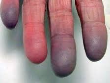 Poor Circulation In Fingers New Health Advisor