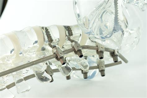 Shows The Implantation Of Pelvic Intramedullary Nail Model Jojenmed
