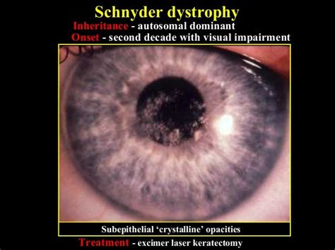 17 Corneal Dystrophies