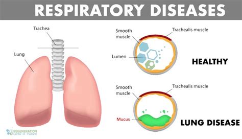 Pin On Lung Regeneration