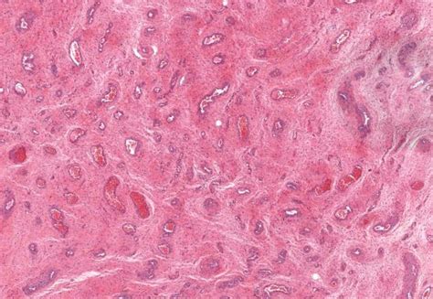 Jerad Gardner Md Whats This Skin Tumor Beautiful Pics By Mahoureihmd Answer And Video