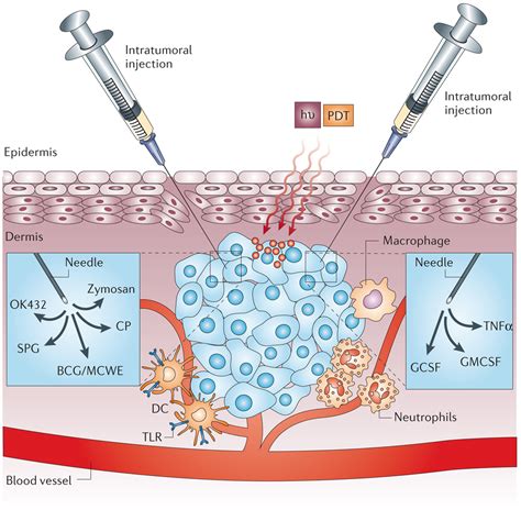 Photodynamic Therapy And Anti Tumour Immunity Abstract Europe Pmc