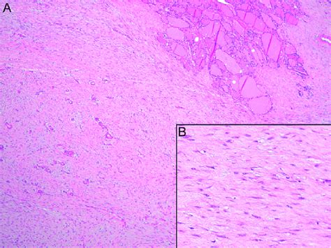 Spindle Cell Proliferation With Atypia At Ethan Fuhrman Blog