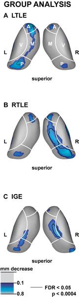 Mapping Thalamic Pathology In Idiopathic Generalized Epilepsy And Temporal Lobe Epilepsy