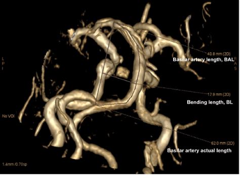 A Vertebrobasiar Dolichoectasia Vbd Patient Who Was Measured Basilar