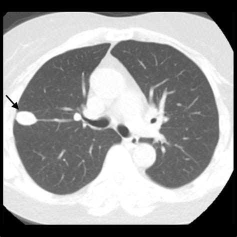 CT Scan Chest Without Contrast CT Chest Without Contrast Showing Download Scientific Diagram