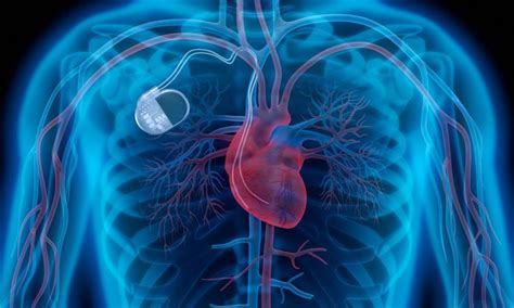 New Leadless Pacemaker Could Be Available To All Heart Patients This