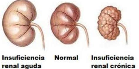 Insuficiencia Renal Y AlimentaciÓn Imeoobesidad