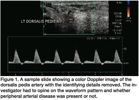Color Doppler Evaluation Of The Pedal Arteries VDM