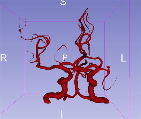 How To Extract 3d Vessels Segmentation Quickly And Accurately