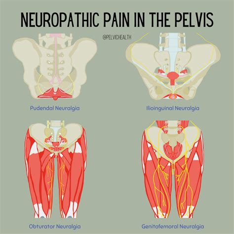 Ilioinguinal Nerve