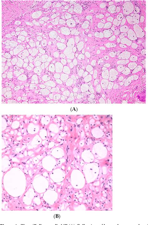 Figure 3 From Histopathological Variants Of Cutaneous Neurofibroma A