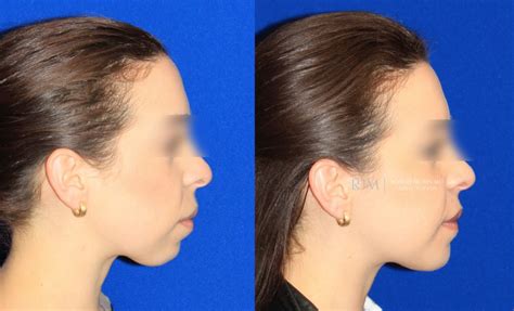 Chin Surgery Photo Gallery Genioplasty Hackensack Nj
