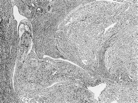 Pathology Outlines Low Grade Endometrial Stromal Sarcoma