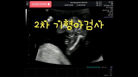 임산부 Vlog 16주 2차 기형아검사 성별확정 Youtube
