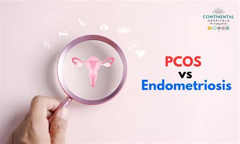 Pcos Vs Endometriosis